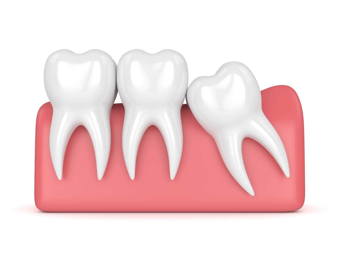 The Steps of Wisdom Tooth Surgery | Ipswich Family Dental